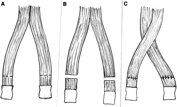 Management of bladder exstrophy epispadias complex in adults: is ...