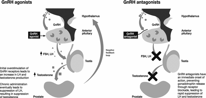 The role of gonadotrophin-releasing hormone antagonists in the ...