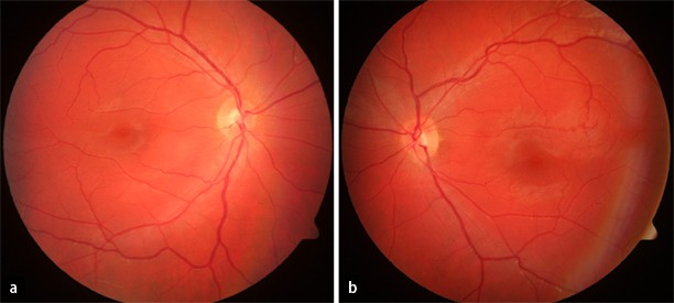 Achromatopsie | SpringerLink