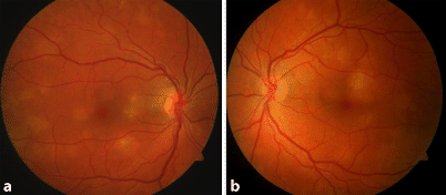 OCT-Angiographie-Befund bei akuter posteriorer multifokaler plakoider ...