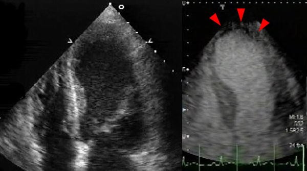 Contrast echocardiography for the diagnosis of left ventricular ...