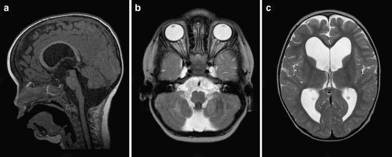 The clinical spectrum of Blake’s pouch cyst: report of six illustrative ...