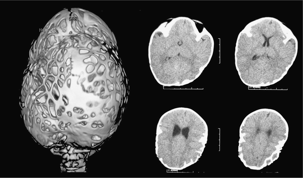 Cloverleaf skull deformity and hydrocephalus | SpringerLink