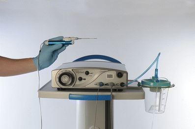 Use of the NICO Myriad device for tumor and cyst removals in a ...