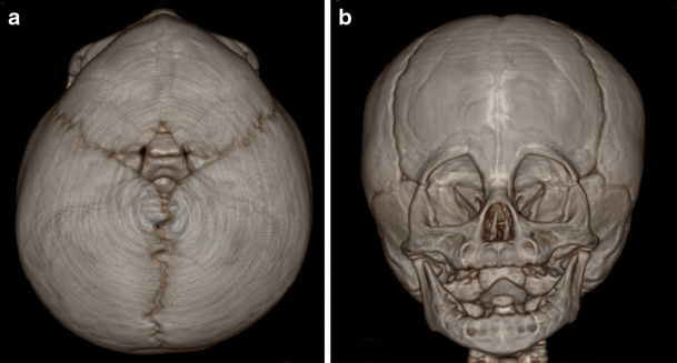 Metopic Synostosis Springerlink