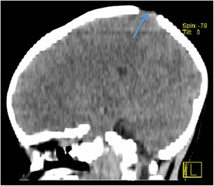 Enlarged parietal foramina: a review of genetics, prognosis, radiology ...