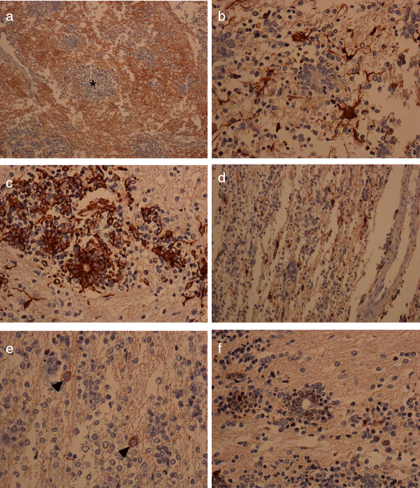 Embryonal tumor with abundant neuropil and true rosettes: an autopsy ...