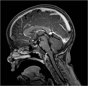 The intracranial bridging veins: a comprehensive review of their ...