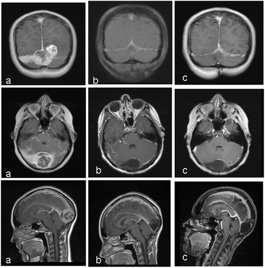 Primary intracranial leiomyosarcoma of the torcular Herophili ...