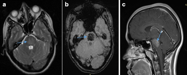 Symptomatic capillary telangiectasia of the pons: three pediatric cases ...