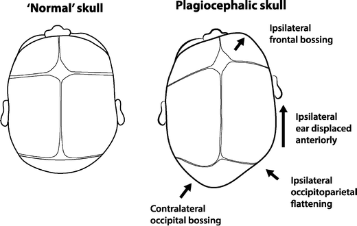 Positional plagiocephaly following ventriculoperitoneal shunting in ...