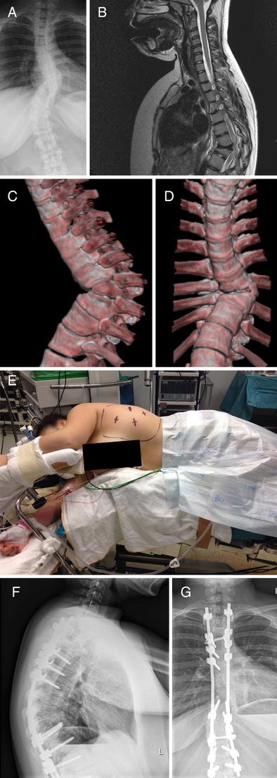 Childhood angular kyphosis: a plea for involvement of the pediatric ...