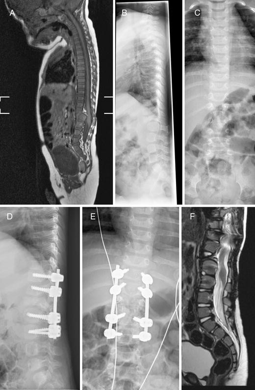 Childhood angular kyphosis: a plea for involvement of the pediatric ...
