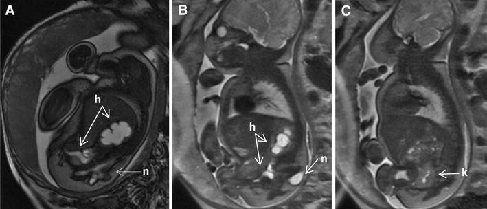 Prenatal counseling for cloaca and cloacal exstrophy—challenges faced ...