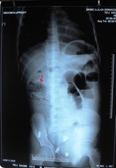 Use of gastrografin in the management of worm-induced small bowel ...