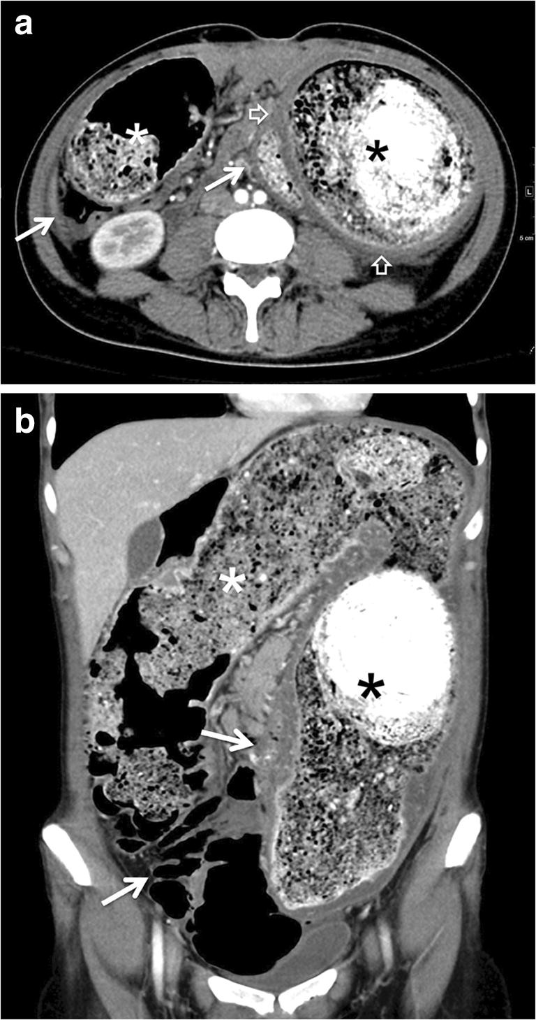 Colonic duplication presenting as a huge abdominal mass in an adult ...