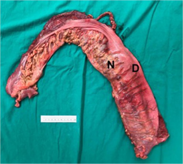 Colonic duplication presenting as a huge abdominal mass in an adult ...