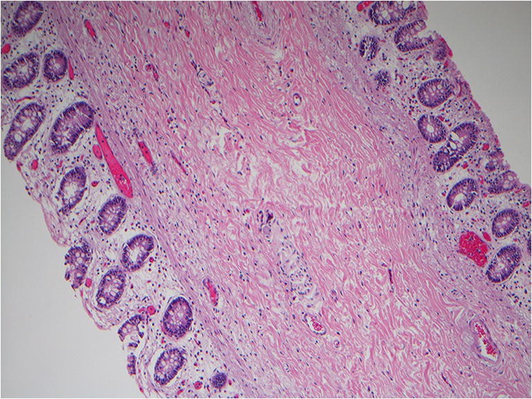 Colonic duplication presenting as a huge abdominal mass in an adult ...