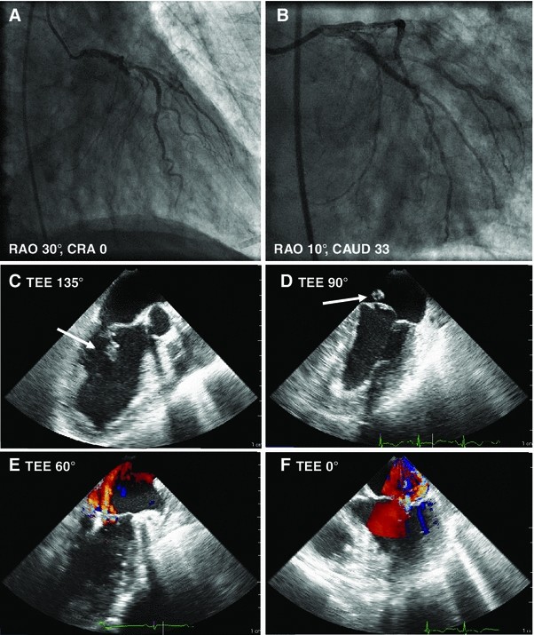 Percutaneous mitral valve repair as rescue procedure after post ...