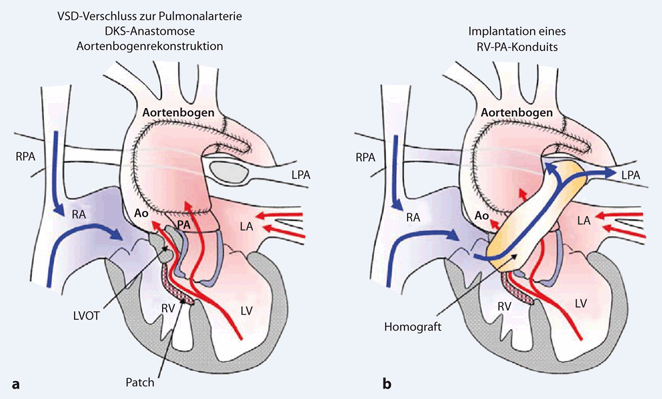 Palliation oder Korrektur seltener komplexer Herzfehler? | SpringerLink