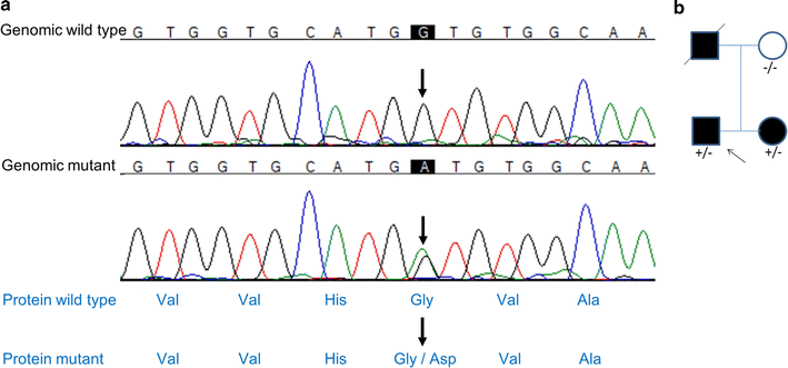 α-Synucleinopathy associated with G51D SNCA mutation: a link between ...