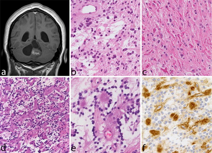 Pilocytic astrocytoma: pathology, molecular mechanisms and markers ...