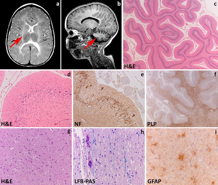Leukodystrophies: a proposed classification system based on ...