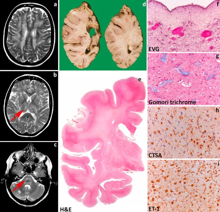 Leukodystrophies: a proposed classification system based on ...
