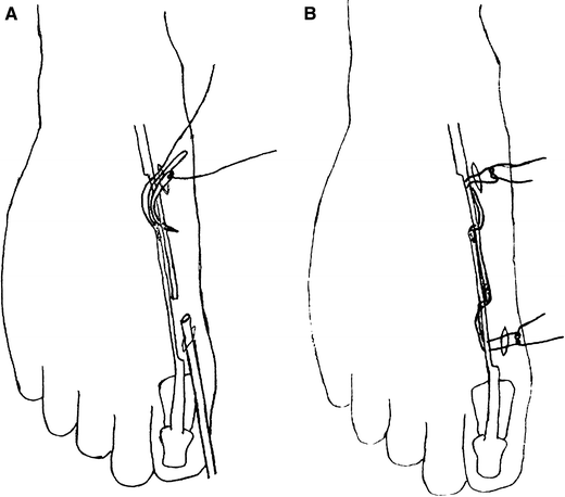Arthroscopically assisted Z-lengthening of extensor hallucis longus ...