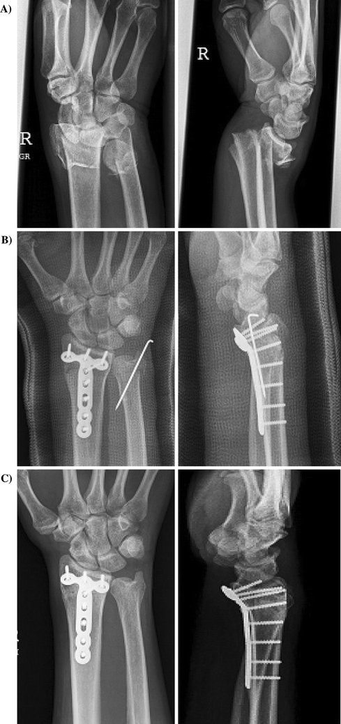 Distal forearm fracture in the adult: is ORIF of the radius and closed ...
