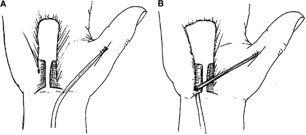 Opponensplasty using palmaris longus tendon and flexor retinaculum ...