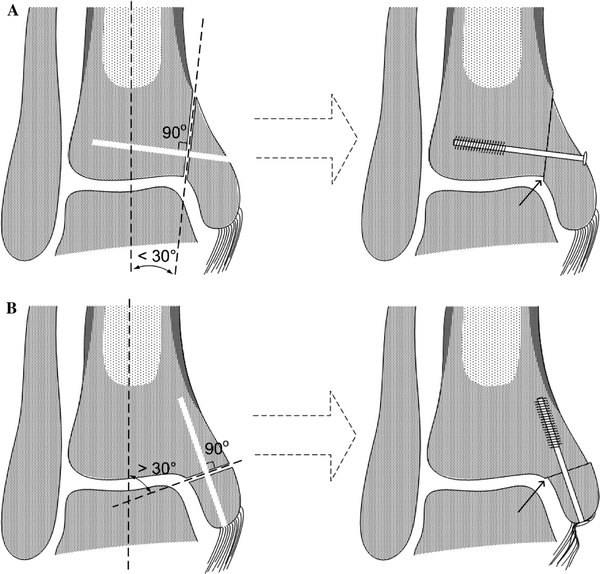 Direction of the oblique medial malleolar osteotomy for exposure of the ...