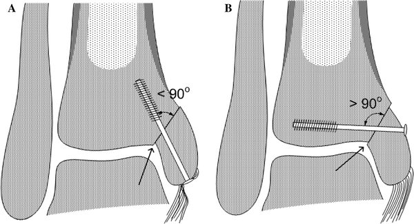 Direction of the oblique medial malleolar osteotomy for exposure of the ...