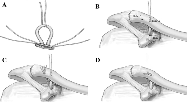 Arthroscopy-assisted reconstruction of coracoclavicular ligament by ...