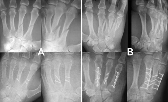 Comparison of treatment of oblique and spiral metacarpal and phalangeal ...