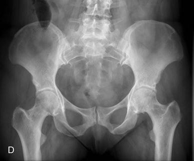 Reliability of Tönnis classification in early hip arthritis: a useless ...