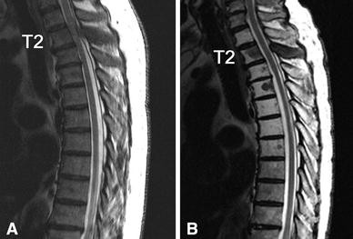 The neurological outcome of radiotherapy versus surgery in patients ...