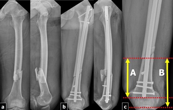 Treatment of infra-isthmal femoral fracture with an intramedullary nail ...