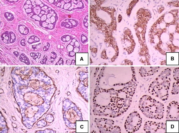 Bartholin Gland Cancer