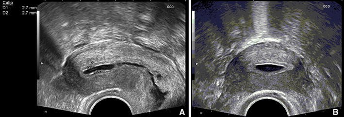 Hysterosalpingo contrast sonography (HyCoSy): let’s make the point ...