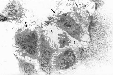 Mucosal changes in chronic hypertrophic rhinitis after surgical ...