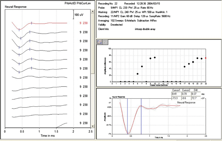 Neural response telemetry in patients with the double-array cochlear ...