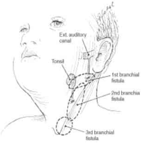 Diagnosis and treatment of branchial cleft anomalies in UKMMC: a 10 ...