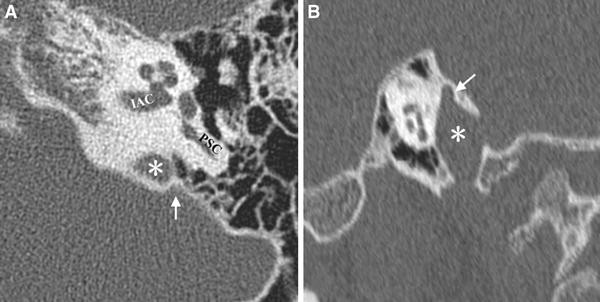 Jugular bulb abnormalities in patients with Meniere’s disease using ...