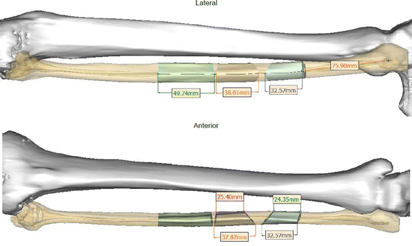Step-by-step surgical technique for mandibular reconstruction with ...