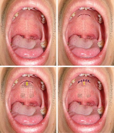 A novel palatal implant surgery combined with uvulopalatopharyngoplasty ...