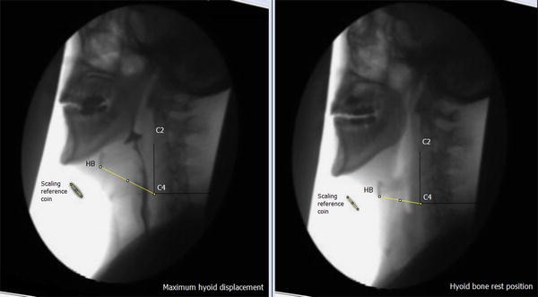 Hyoid bone displacement as parameter for swallowing impairment in ...