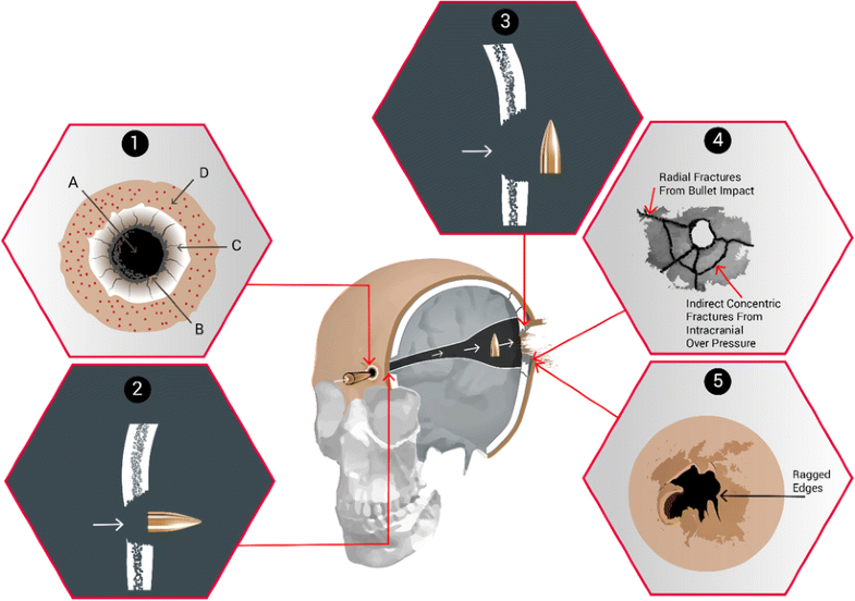 Ballistic impacts on an anatomically correct synthetic skull with a ...