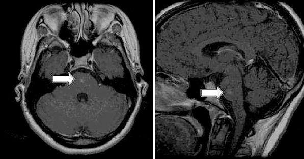 Pontine capillary telangiectasia as visualized on MR imaging causing a ...