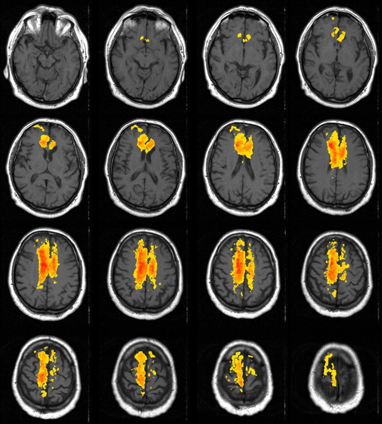 Clinical and MRI patterns of pericallosal artery infarctions: the ...